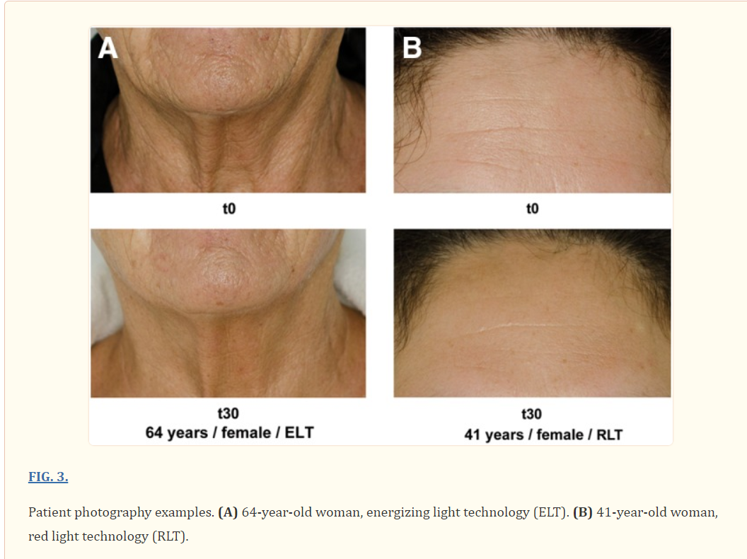 Red Light Therapy For Skin Benefits: Beauty & More
