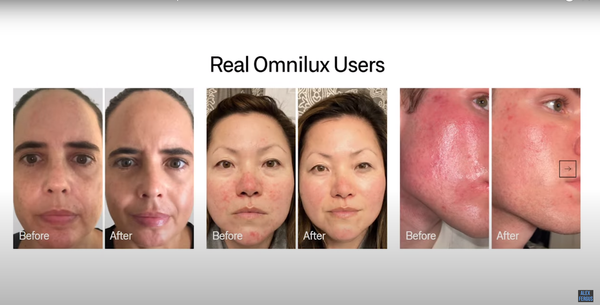 I Tried The Omnilux Mask For 5 Weeks: Surprise? (+Review)