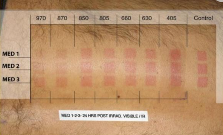 Red Light Therapy For Sunburn: Prevention And Treatment