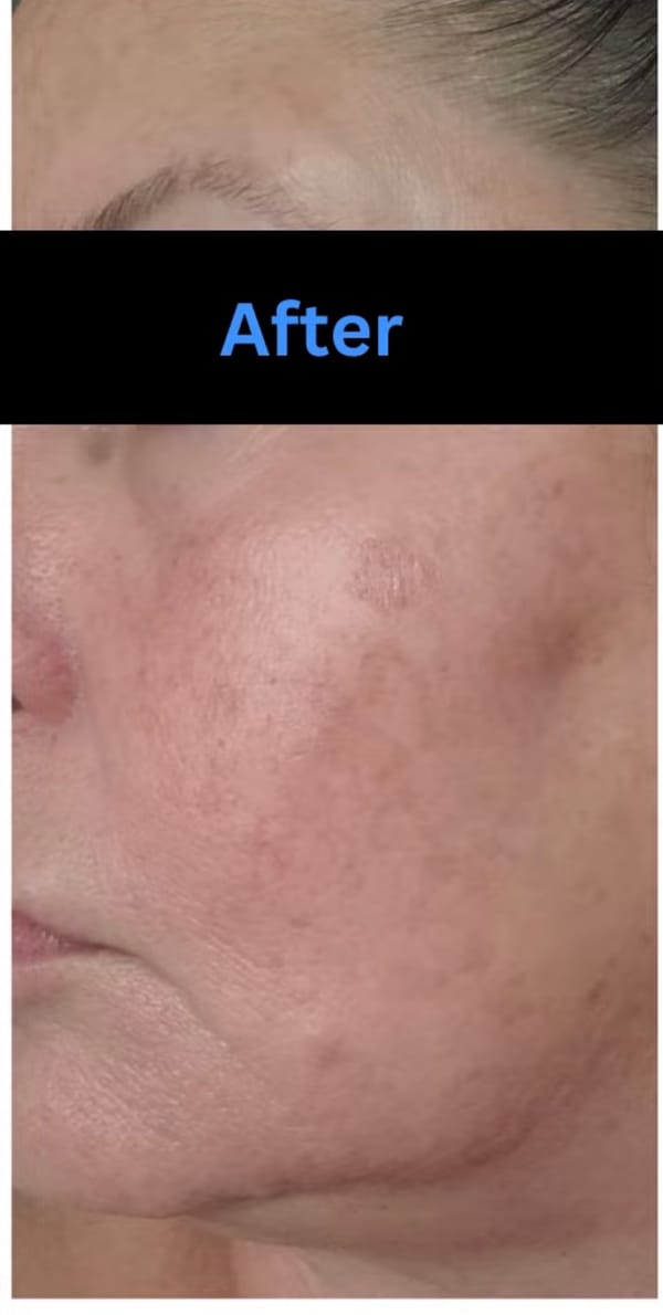 Red Light Therapy For Face Before And After: Unbelievable Results!